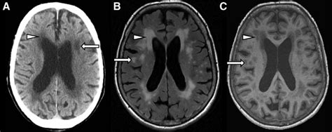 Mri