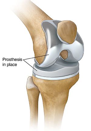 Total Knee Replacement Saint Luke S Health System