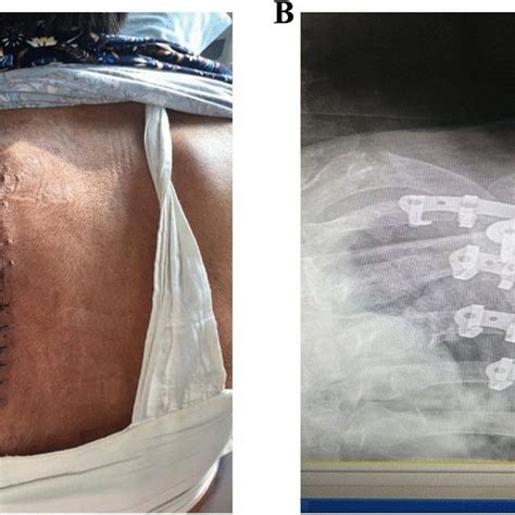 Median Sternotomy Incision Was Made And The Chest Muscles Were Download Scientific Diagram