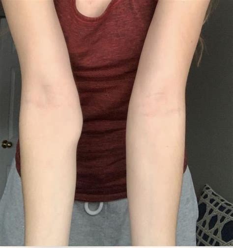 Random Lump On Medial Aspect Of Elbow Rmedicaladvice