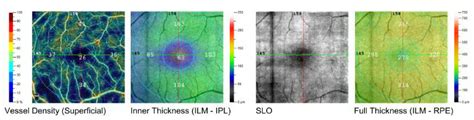 github ncbi codeathons optical coherence tomography angiography in