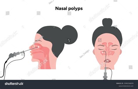Nasal Endoscopy Procedure Nasal Sinus Passages Stock Vector Royalty