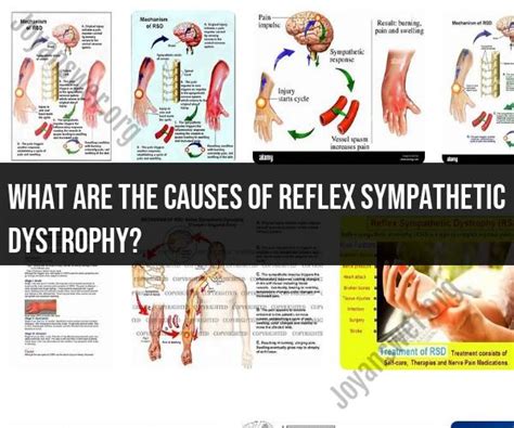 What Is Sympathetic Dystrophy At Geraldine Givens Blog