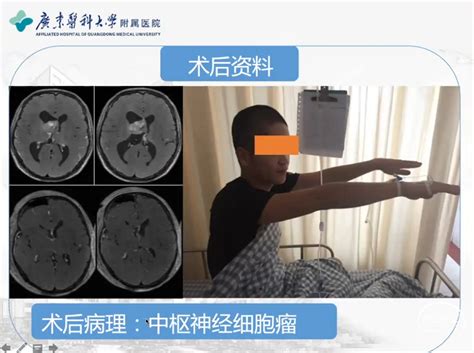 门东海主任医师：侧脑室肿瘤的显微手术治疗 脑医汇