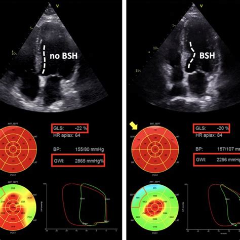 Average Global And Segmental Pressure Strain Loops Of The Three