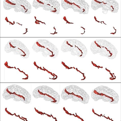 The Three Patterns Detected For The Left Cingulate Sulcus Row 1 3 5