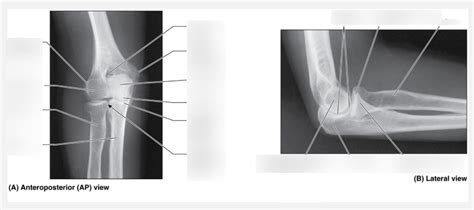 Elbow Radiograph Diagram Quizlet