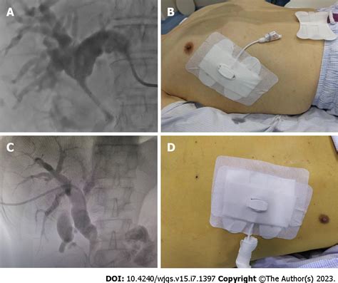 Eusguided Biliary Drainage For Patients With Malignant