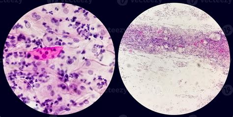 Paps Smear Microscopic Examination Of Pap Smear Showing Inflammatory