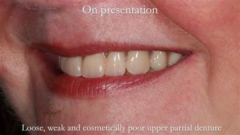 Finlays Newsletter 58 Gasket Upper Partial Denture For Zoe Finlay Sutton Denture Education