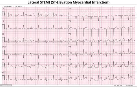 Lateral Stelevation Myocardial Infarction 12 Lead Ecg Common Case 6 Sec