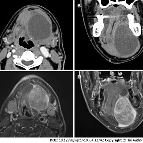 Computed Tomography And Magnetic Resonance Imaging Findings Of Myxoid