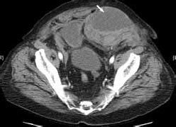 Rectus Sheath Hematoma Consultant