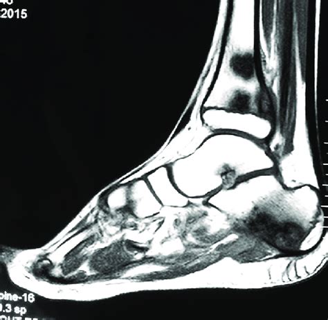 Mri T2w Sagittal Image Showing Multiple Osteolytic Lesions In Tibia Download Scientific