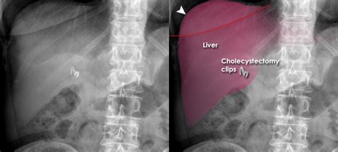 Psoas Sign X Ray
