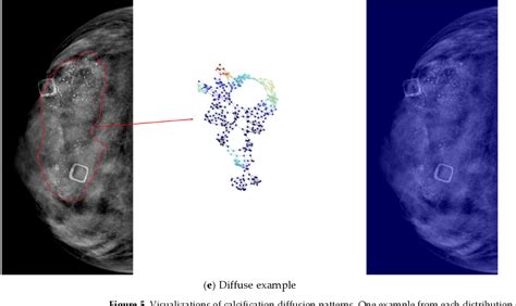 Figure 1 From End To End Calcification Distribution Pattern Recognition For Mammograms An