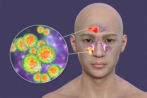 Streptococcus Mutans Bacteria Cause Sinusitis Illustration Showing