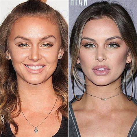 Celebrity Cheek Fillers Before And After 60 Photos Moonagedaydream Film