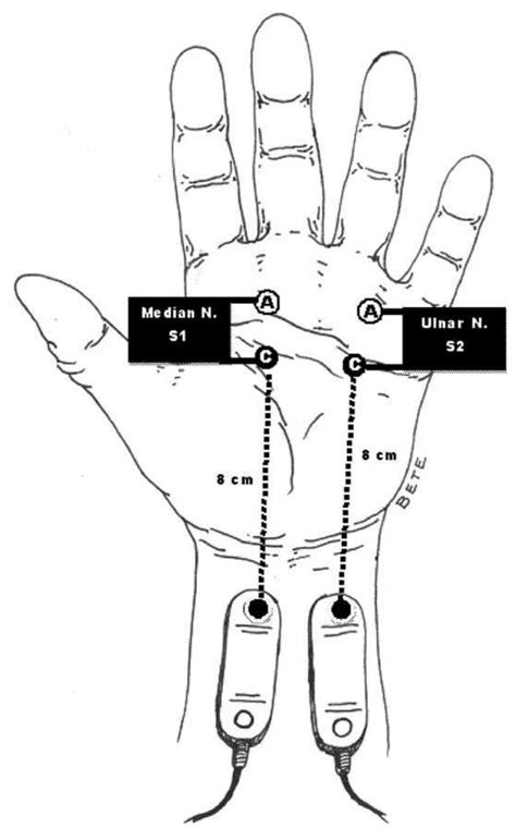 Figure 3 From Electrodiagnostic Evaluation Of Carpal