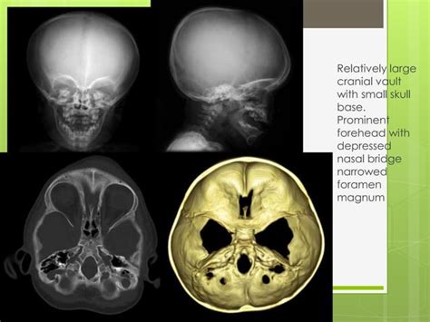 Achondroplasia Pseudoachondroplasia Hypochondroplasia