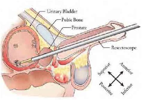 Overview Of The Turbt Procedure The Resectoscope Is Inserted Through