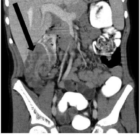 Typical Appearance Of Intussusception Due To Intramural Tumour In Mri Download Scientific Diagram