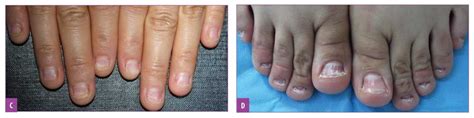 Alopecia Areata Nails