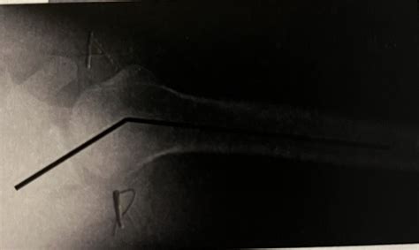 Fxs Of Proximal Humerus Flashcards Quizlet