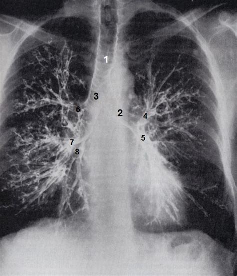 Bronchogram Diagram Quizlet