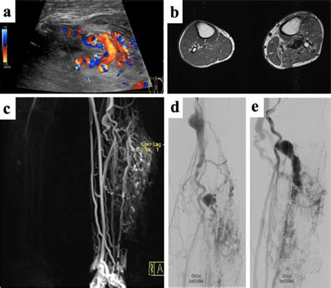 Arteriovenous Malformation Of The Lower Limb With Associated