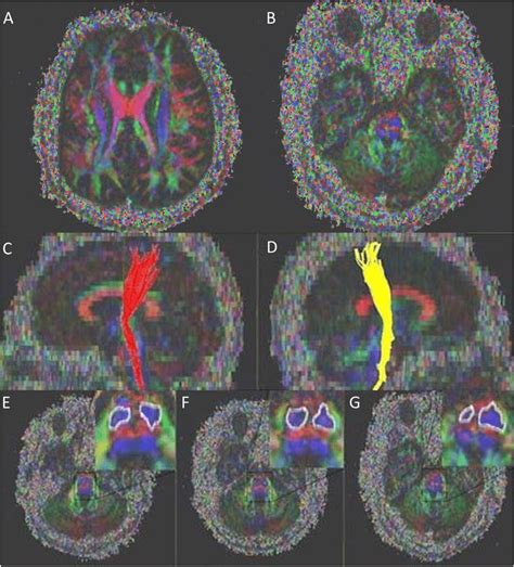 Axial Color Coded Fractional Anisotropy Map Demonstrating The Download Scientific Diagram
