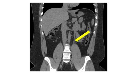 CT Scan Coronal View With Left Ureter 2 Mm Stone Arrow American