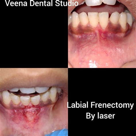 Labial Frenectomy