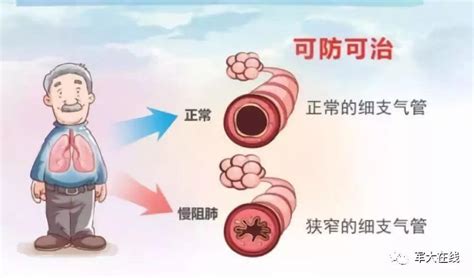 哮喘、慢阻肺、肺炎，最容易打垮老年人的三种肺疾病应如何应对 知乎