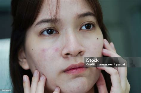 여드름과 피부 얼굴에 흉터 피지선의 장애 십대 소녀 스킨 케어 미용 문제 20 24세에 대한 스톡 사진 및 기타 이미지 20
