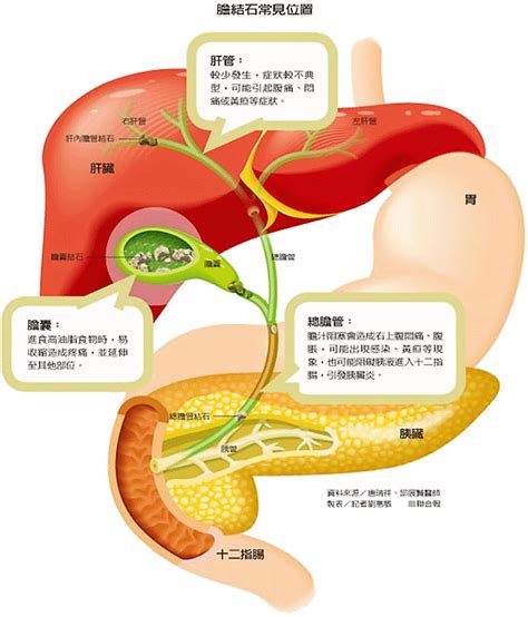 健康主題館》年輕人吃太好 養出膽結石》暴食高糖高脂或長期節食 都易成了「石頭族」 信偏方無效 摘膽囊別拖》小心拖久了，讓結石「愈滾愈大
