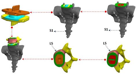 Replacement Of The Prodisc L ® Type Fixed Spherical Core Prosthesis 45