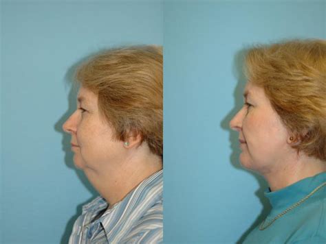 Facelift Before And After Photo Gallery San Francisco Ca Kaiser