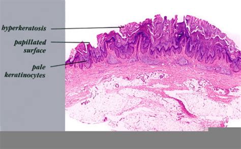 Hyperkeratosis Histology