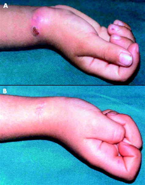 What Is The Radial Artery With Pictures