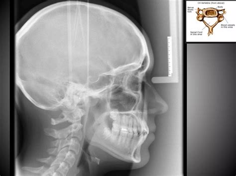 Lateral Cephalometry In Orthodontics Pptx