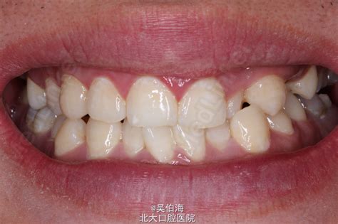 拥挤牙列的排齐 非拔牙 医联