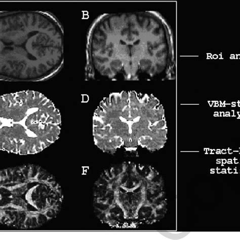 Diffusion Tensor Based Images A And B Show Axial Horizontal And