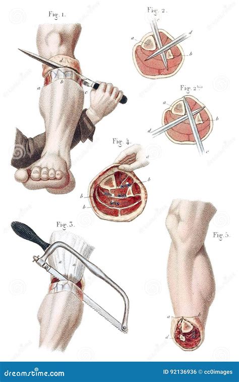 Amputation Of The Leg Picture Image 92136936