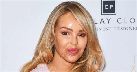Katie Piper Admits I Find It Hard As She Gives Insight Into Operation