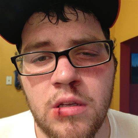 Black Eye And A Split Lip Makeup Designs Square Glass Lips Person