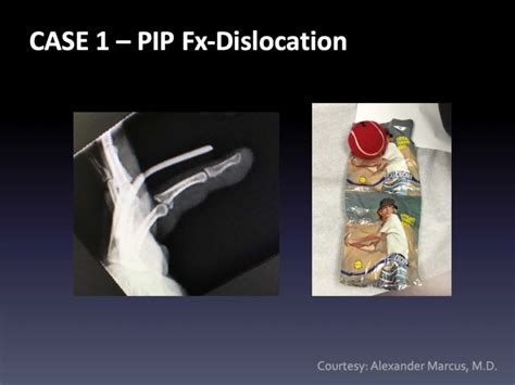 Case 1 Pip Fx Dislocation Virak Orthopedics