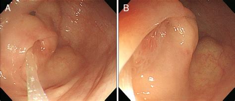 Colonoscopic Findings Of The Orifice Of Appendix A Colonoscopy