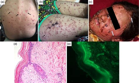Erythema Multiforme Minor Hand