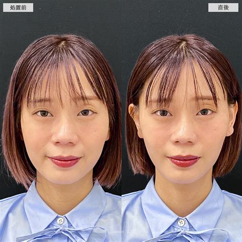 リフトアップしてひと回り小さなお顔に♪aスレッドの処置前と直後の症例です30代女性 美容整形クリニックa Clinic【公式】